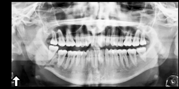 Fractured Cheekbone X Ray