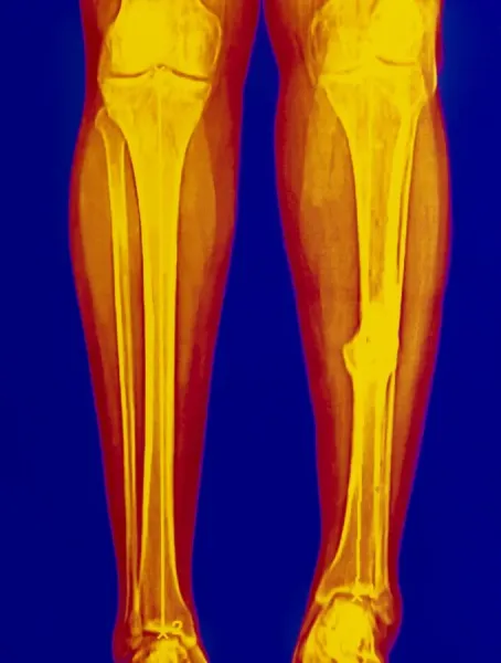 Leg Bones X Ray