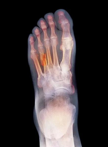 Xray Broken Foot Talus Fractures (foot) New York Fracture Care
