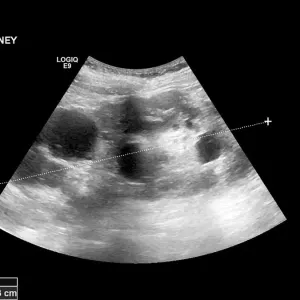 Lissencephaly Ultrasound