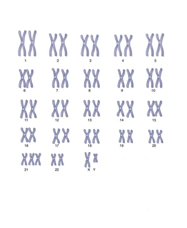 Down Syndrome Karyotype KARYOTYPE & SYMPTOMS OF DOWN'S SYNDROME